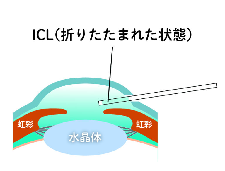 ICLはやめた方がいい?ICLのメリット･デメリットについて解説 | コラム – 経堂こうづき眼科
