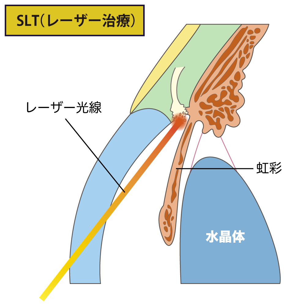 目薬しない緑内障治療?「SLT(レーザー治療)」の効果,メリット,向いていない人など徹底解説 | コラム – 経堂こうづき眼科